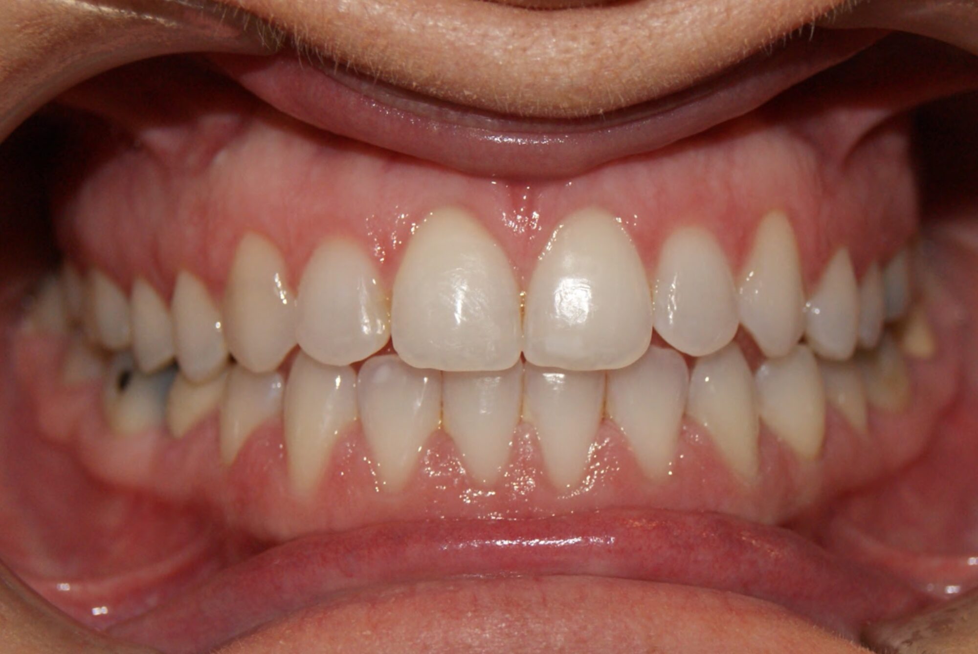 Top Invisalign® Provider in Lawrence & Topeka, KS