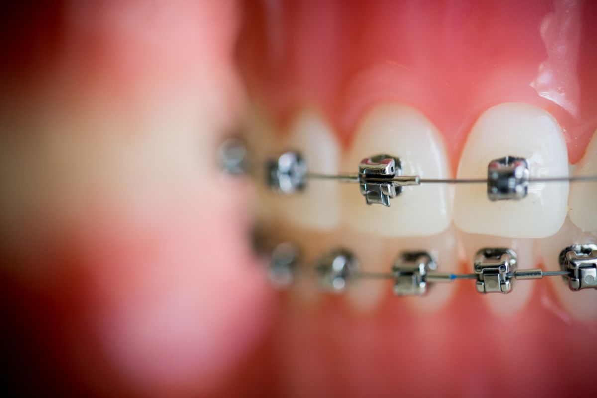 When Do I Get My Braces Off? | Oread Orthodontics